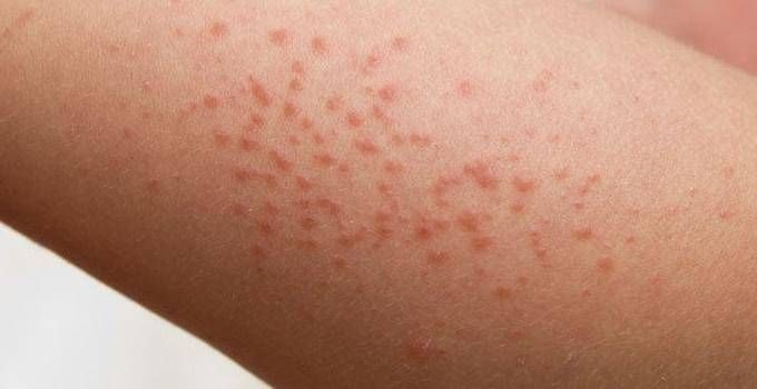 Punaise de lit : Piqûre & Bouton - Traitements pour s'en débarrasser